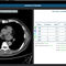 Medical software - LCS PLUS - Coreline - CT / analysis / AI-based