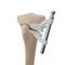 Tibia osteotomy plate - Aplus Biotechnology - proximal / locking / titanium