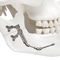Mandibular distractor - Jeil Medical Corporation - internal / adult