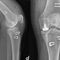 Unicompartmental knee prosthesis - UNICAP - Arthrosurface - cemented