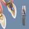 Cylindrical dental implant - blueSKY - bredent medical - titanium ...