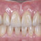 PEEK dental material - Pekkton® ivory - Cendres+Métaux SA - for dental ...