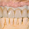 PEEK dental material - Pekkton® ivory - Cendres+Métaux SA - for dental ...