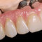 PEEK dental material - Pekkton® ivory - Cendres+Métaux SA - for dental ...