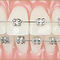 Metal orthodontic bracket - Micro Sprint® - FORESTADENT BERNHARD ...