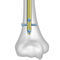Humeral intramedullary nail - TDM - mid-shaft fixation / proximal fixation / distal fixation