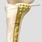 Tibia compression plate - Trifix - TDM - proximal / medial / lateral