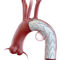 Ascending thoracic aorta stent graft - Relay® Proximal Scallop - Terumo ...