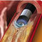 Surgical laser - CVX-300 - Spectranetics - atherectomy / excimer ...