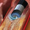 Laser atherectomy catheter - ELCA - Spectranetics - coronary