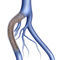 Venous stent - VENOVO® - Bard Medical