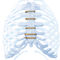 Sternal closure bone cerclage wiring - ZIPFIX™ - Depuy Synthes ...