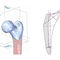 Primary hip prosthesis - TriFit TS™ - Corin - cementless