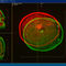 Medical imaging software - NeuroBlate ® SoftwareTM NeuroBlate ...