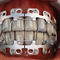 Mandibular distractor - QuickFix™ MMF - Acumed - external / adult