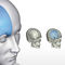 Custom-made cranial implant - Matrix Omnipore® - Acumed
