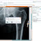 Hip surgery software - Hip Arthroplasty - OrthoView - orthopedic ...