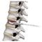 Needle spine augmentation system - AFFIRM® - Globus Medical ...