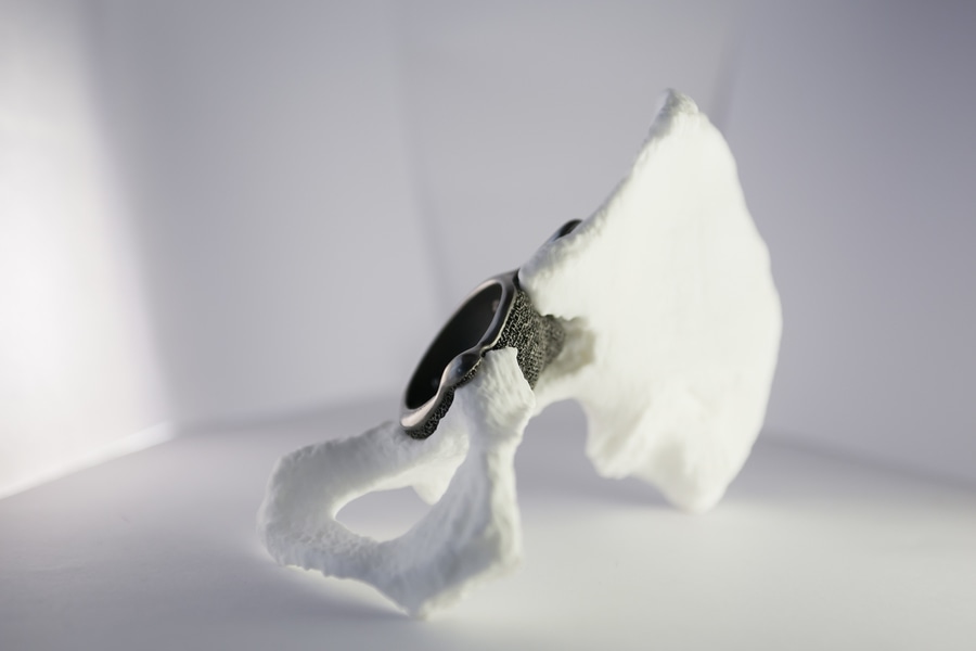 Custom-made acetabular implant for hip joint revision (W.G. Paprosky 3A ...