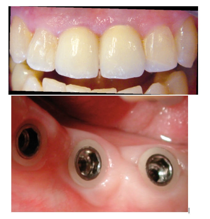 An implant revolution: the world's only Zirconia collar - Titanium body ...