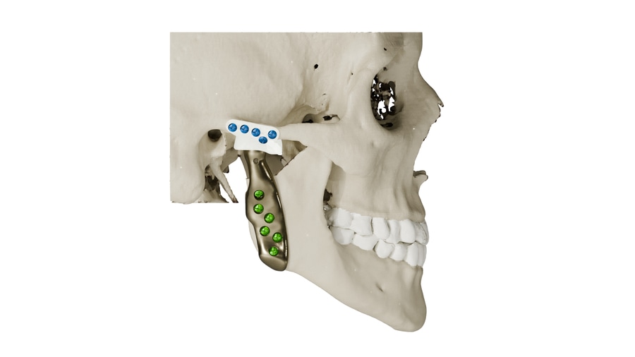 Precision in Motion: Custom TMJ Replacements - Stellenbosch, South ...