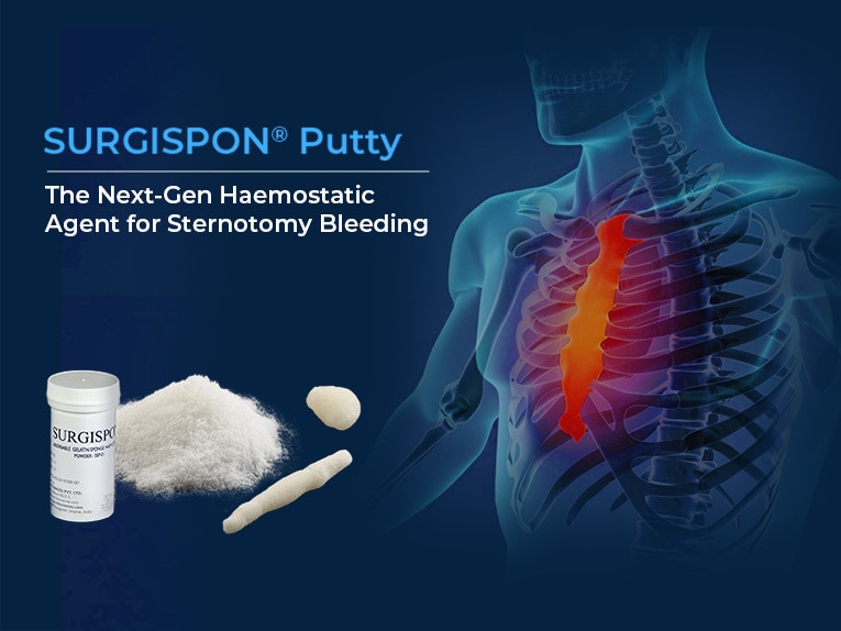 SURGISPON® Putty: The Next-Gen Haemostatic Agent for Sternotomy ...