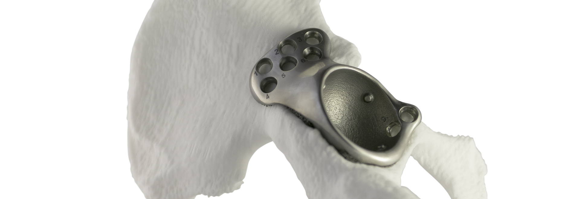 Custom-made acetabular implant for hip joint revision (W.G. Paprosky 3A ...