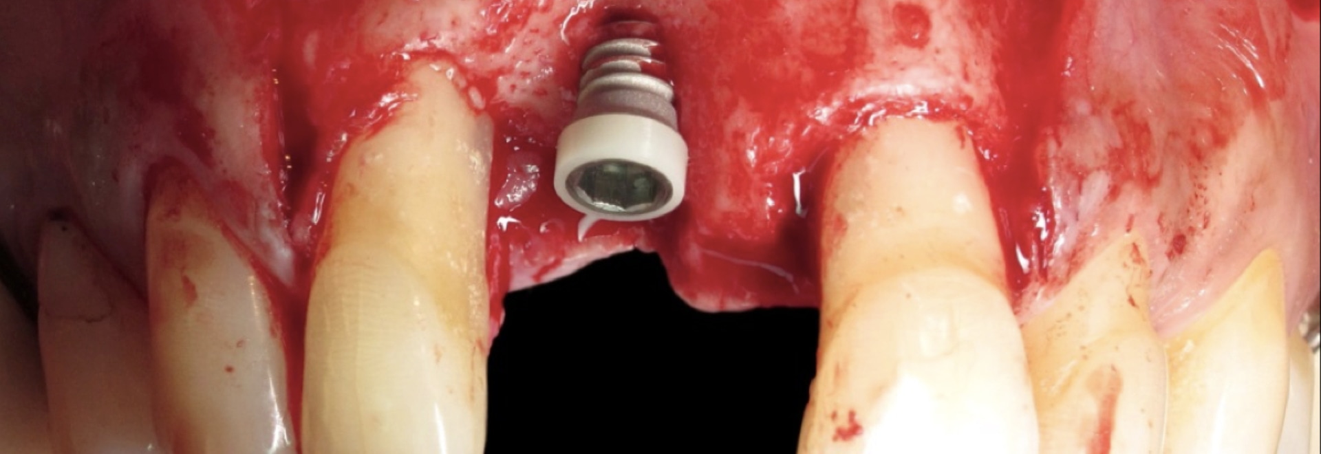 Best implant for the site - Rodez, France - TBR Implants Group