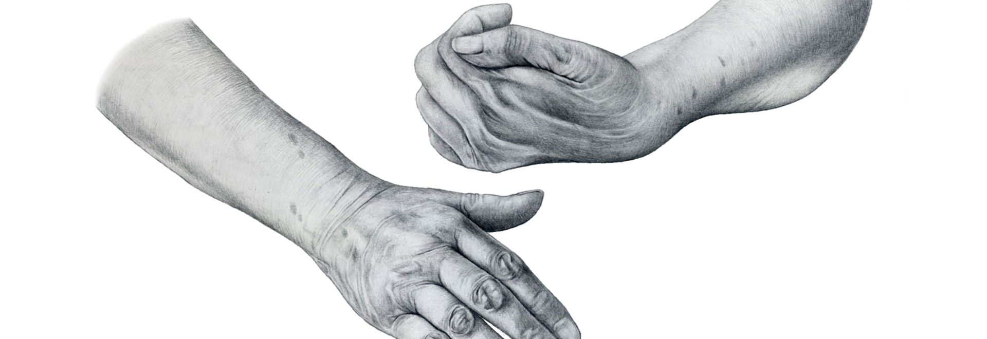 Occupational Therapy For Hemiparesis Los Angeles CA USA SIFSOF