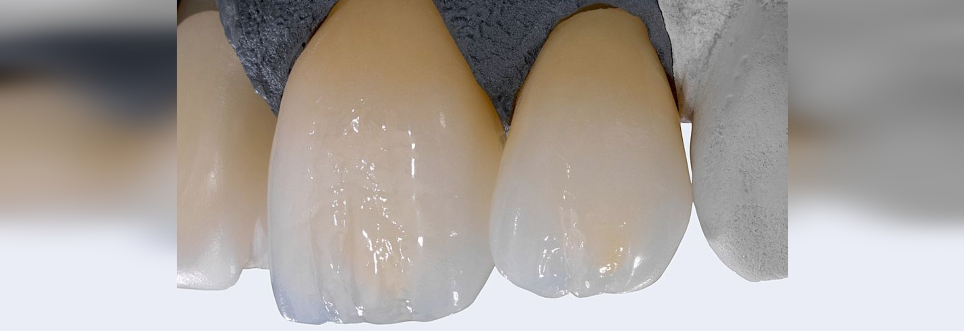Super-high translucent zirconia Ceramill Zolid FX for highly aesthetic ...