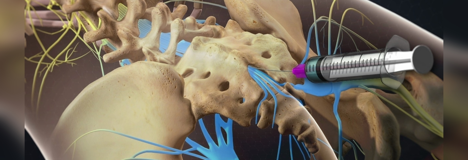 Ultrasound-guided Caudal Injection - Los Angeles, CA, USA - SIFSOF