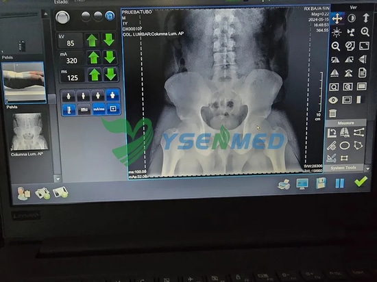 Mexican radiologist is happy with YSENMED portable digital x-ray system ...