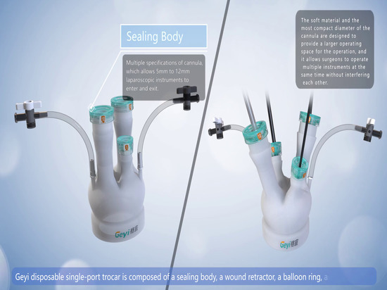 single port laparoscopy surgery - Hangzhou, Zhejiang, China - Zhejiang ...