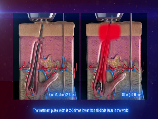 Smart Medical Aesthetics Leads a New Era - PZ Laser Diode Laser Hair ...