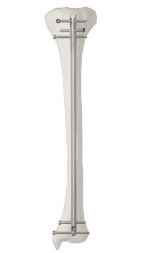 脛骨用髄内釘 - Da Vinci™ - AOS - Advanced Orthopaedic Solutions - 近位固定 / 遠位固定