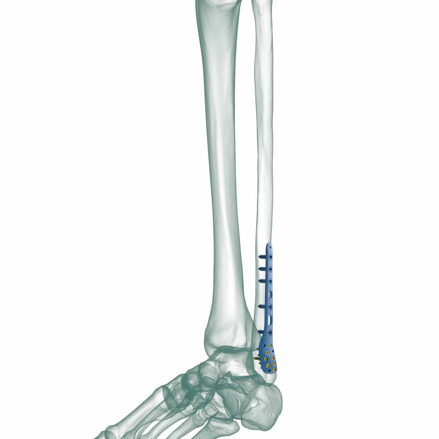 腓骨用圧迫プレート - TRUE LOCK Distal Fibula Posterolateral - Truemed Medical - 末端 / 後外側 / ロッキング