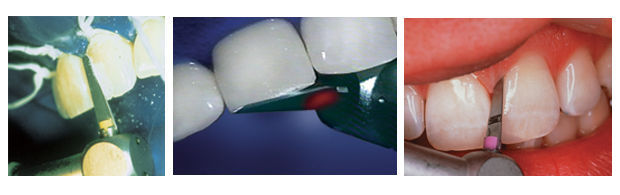 歯科コントラアングル / 空気 / ミニチュア - Profin PDX - DENTATUS AB - 動画