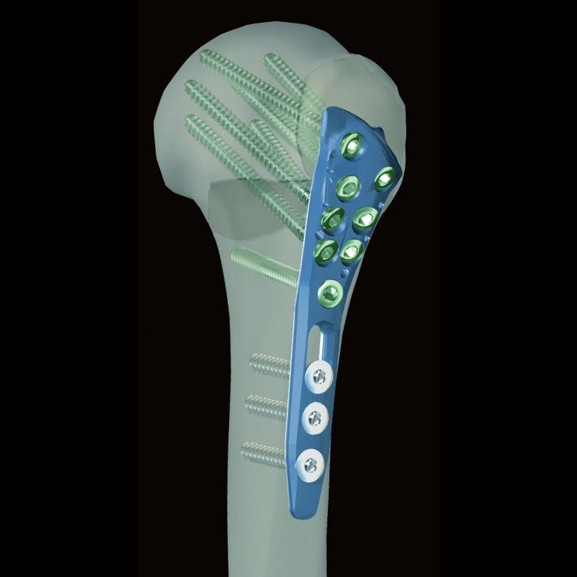 上腕骨用圧迫プレート - Alians Proximal Humerus - Newclip Technics - 近位部 / ロッキング / ノンロッキング