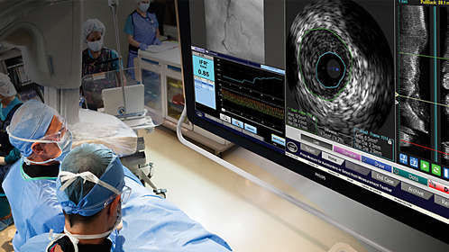 分析ソフト - CORE™ - Philips Volcano - 血管内超音波検査（IVUS）用