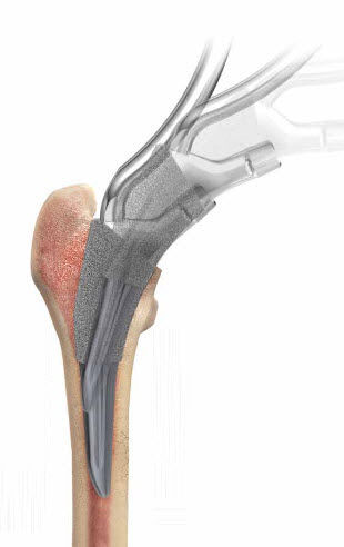 初回の人工股関節 - Tri-Lock® - Depuy Synthes - セメントレス