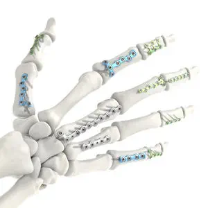 鎖骨用圧迫プレート - Jeil Medical Corporation - 側面 / 内側 鎖骨用圧迫プレート - Jeil Medical Corporation - 側面 / 内側