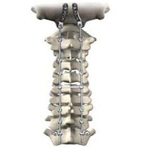 後頭-頸椎-胸椎骨接合システム - OASYS® - Stryker - 後方進入