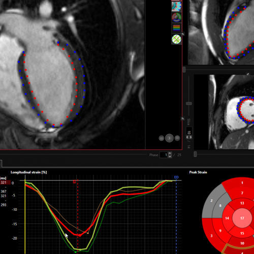 医療用ソフト - Caas MR Strain - Pie Medical Imaging - 診療所用 / MRI用 / 心臓病学用