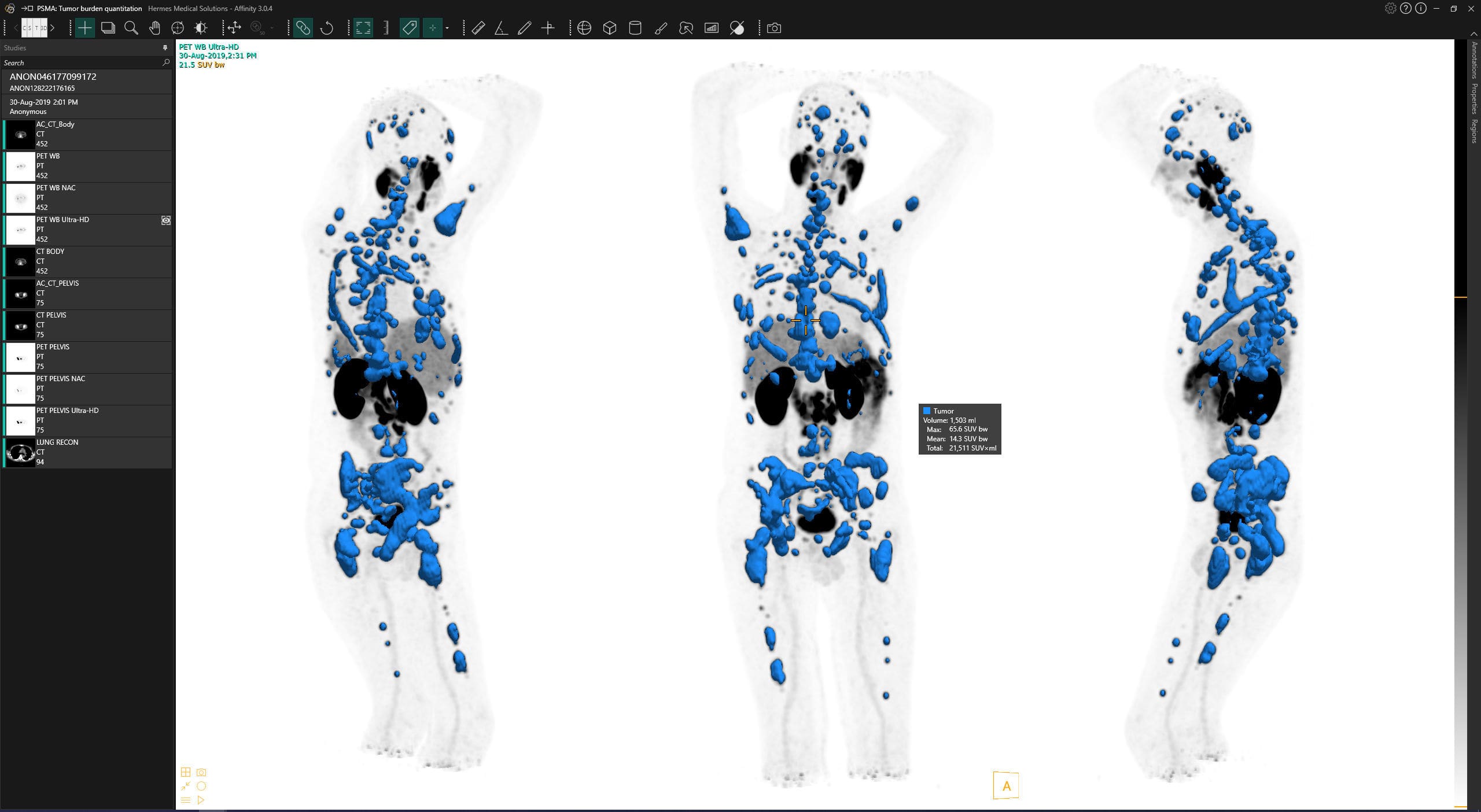 Software de tratamento - Voxel dosimetry™ - Hermes Medical Solutions ...