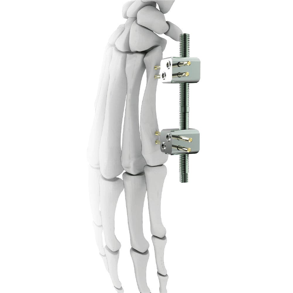 Fixador externo para articulação metacarpofalangeana - minifix ...