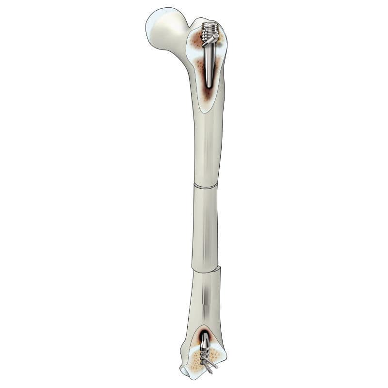 Haste intramedular para fêmur - D-SCOPE - Peditst - fixação proximal ...