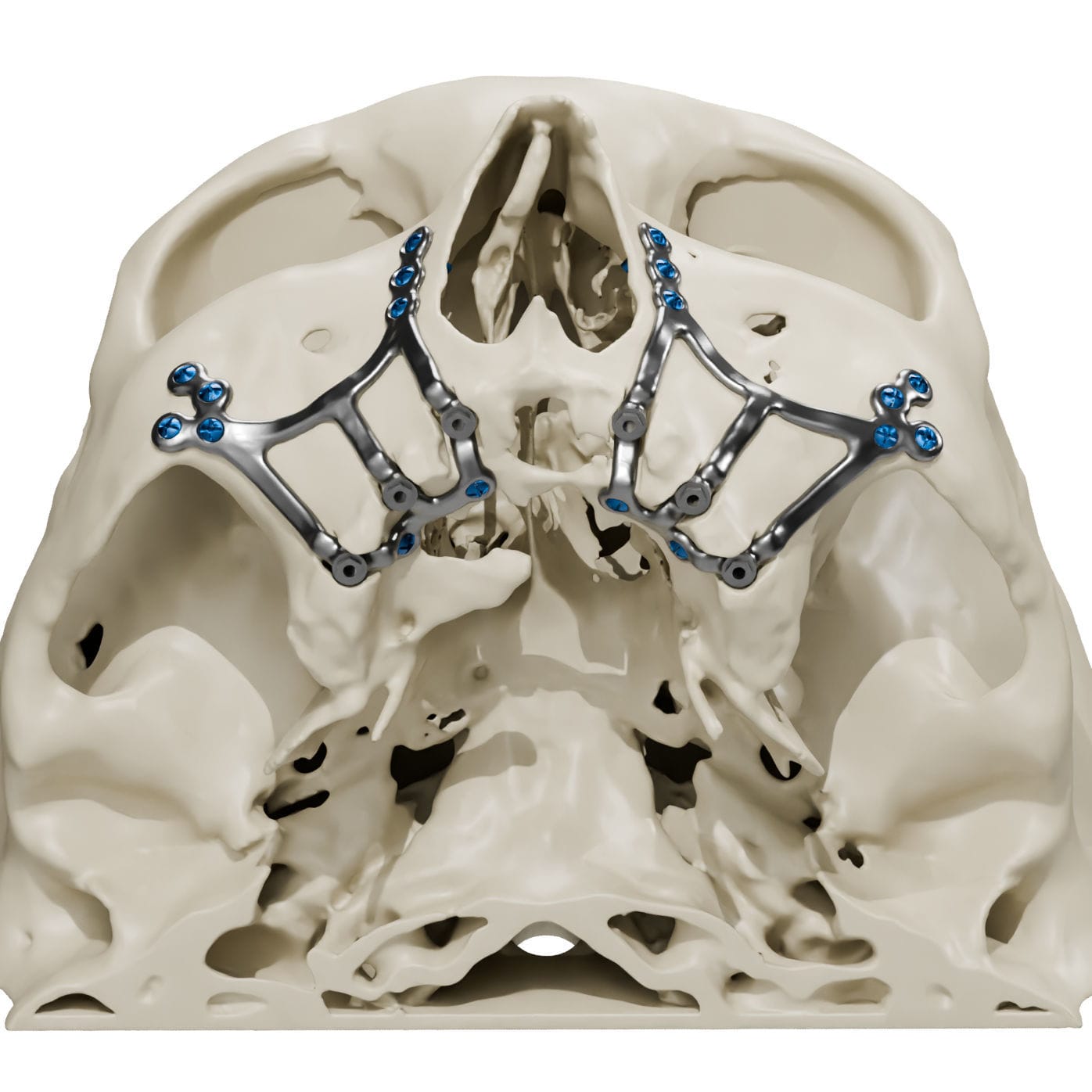 Implante subperiosteal sob medida - Craniotech - em titânio / anatômico ...
