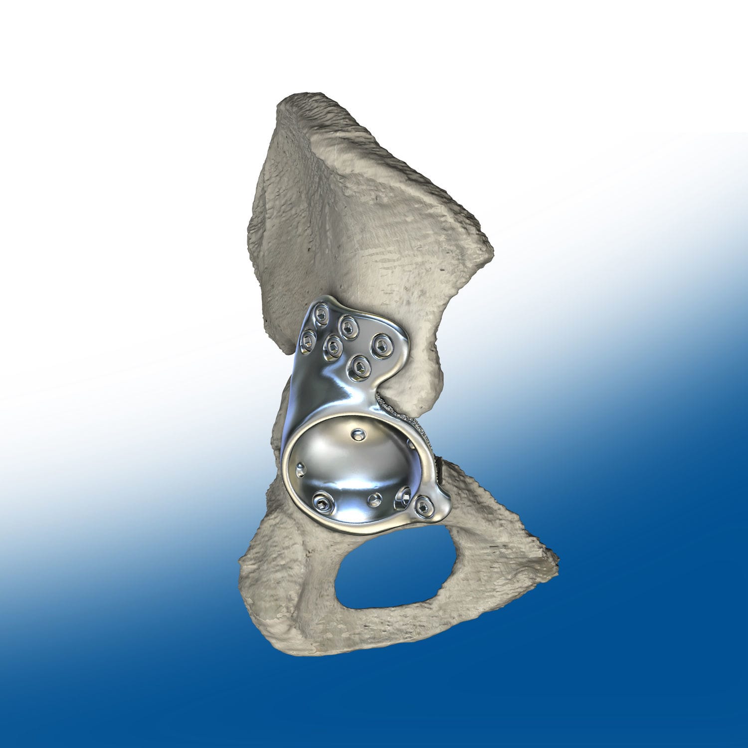 Prótese acetabular de revisão - Ortho Baltic - cimentada