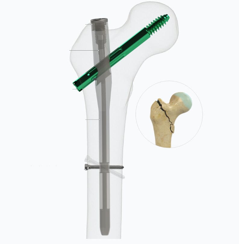 Haste intramedular para fêmur - Zimed Medical - fixação proximal / metálica