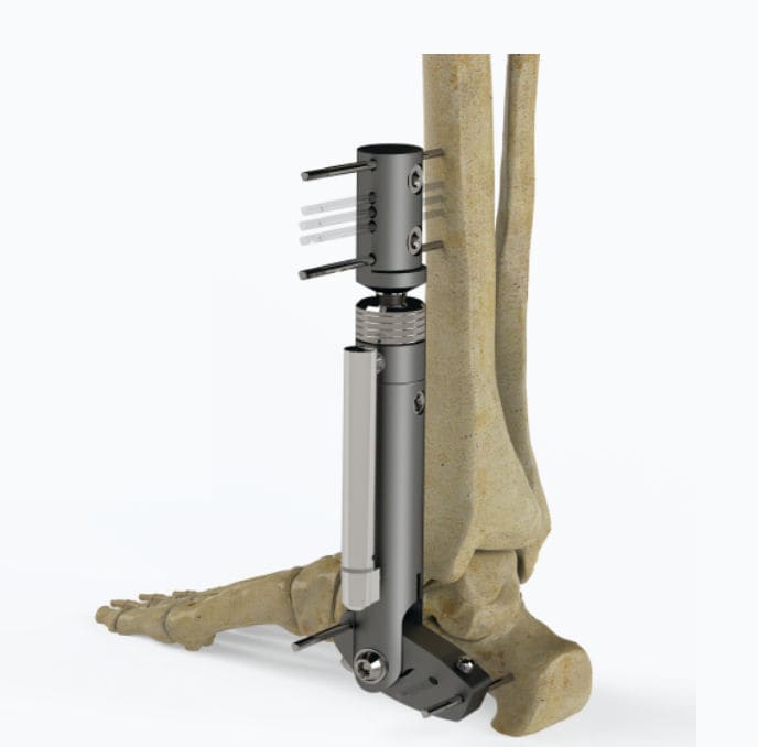 Fixador externo para tornozelo - 5064-000 series - Zimed Medical - tubular